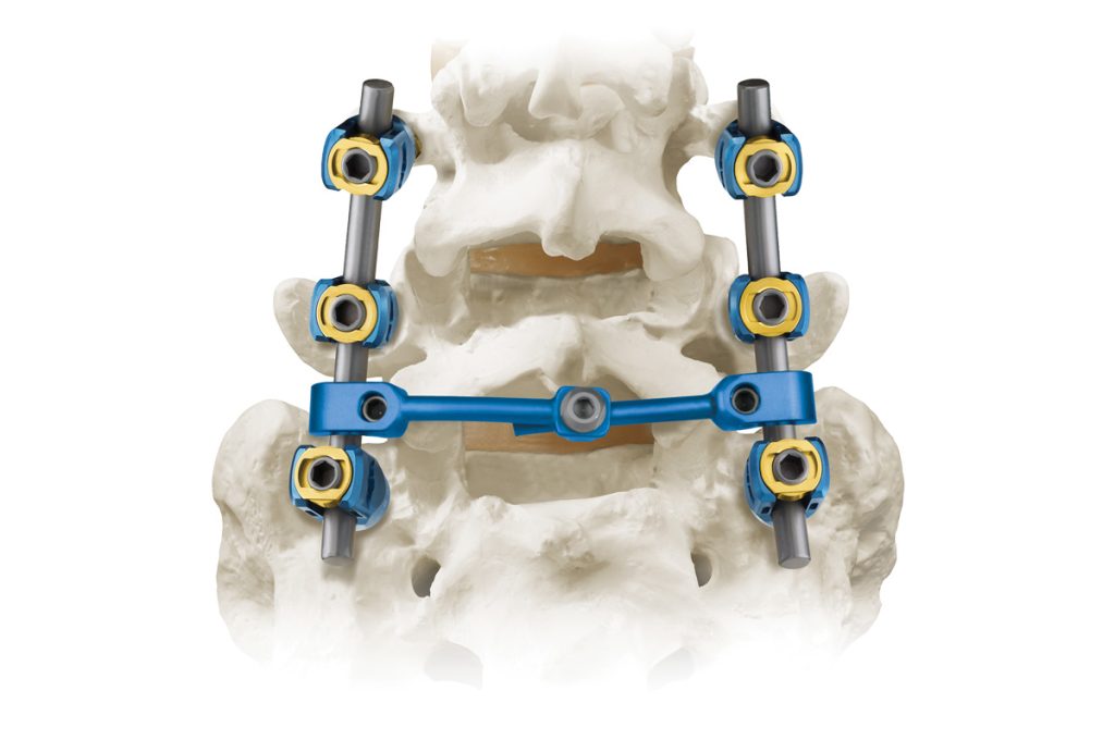 Importado - NeuroSpine | Implantes Quirúrgicos